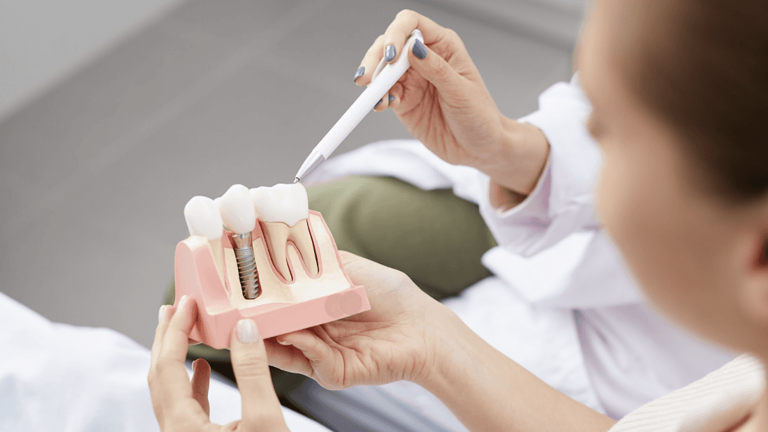 The Benefits of Dental Implants | Dental Implants Vancouver BC